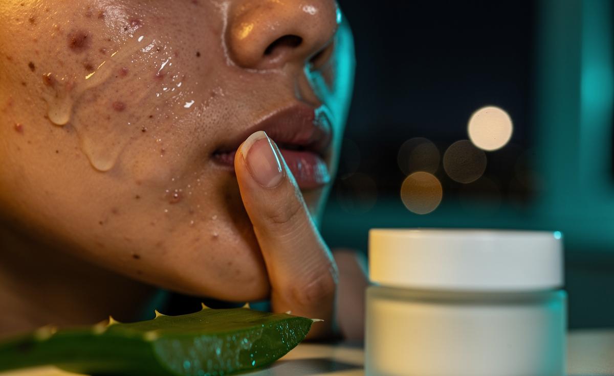 The Magic of Aloe Vera for Acne Scars: How It Reduces Spots Overnight ...